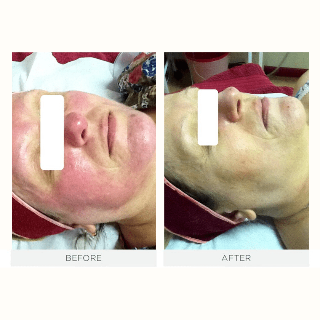 LED Light Therapy Facials Gold Coast | LED Light Therapy | LED Facials